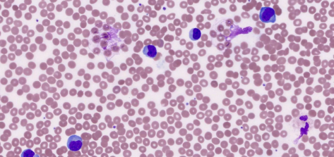 Understanding High Lymphocyte Symptoms: A Comprehensive Guide